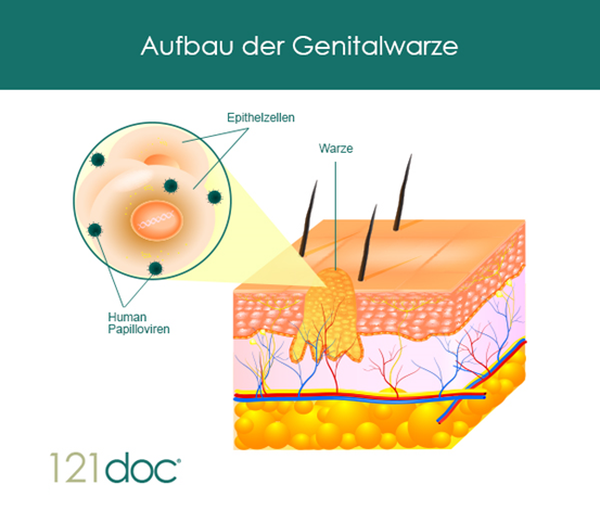 ᐅ Feigwarzen Behandlung: Medikamente & Rezept | 121doc