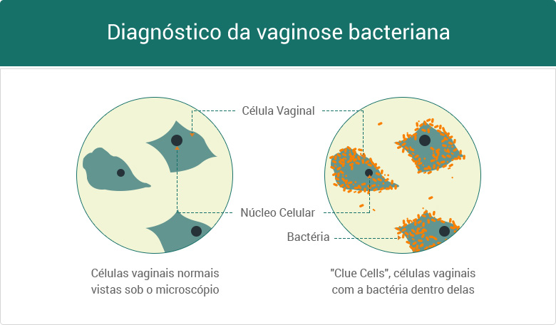 Vaginose Bacteriana | Causas, Sintomas e Tratamento | 121doc PT