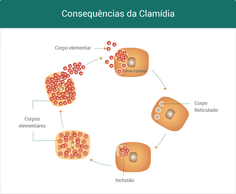 Clamídia (Chlamydia Trachomatis) | Sintomas e Tratamentos